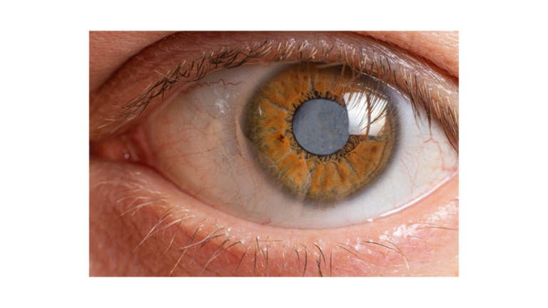 What Are Cataracts? 3 Key Facts You Should Know - DOCTOR DOAN